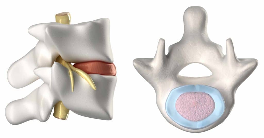 Hernie discale : la chiropraxie aussi