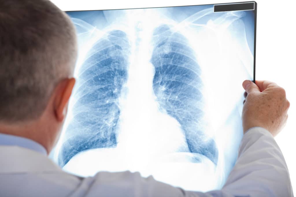 Micronodules pulmonaires : une surveillance s'impose.